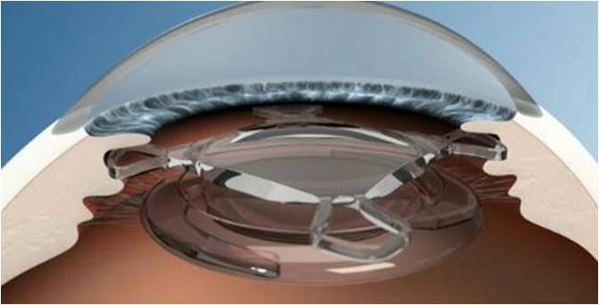 Add on lens - Eye Correction Center